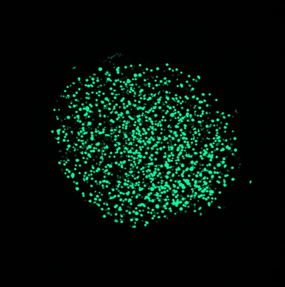 First success for Personalized Functional Profiling (PFP) of gastro ...